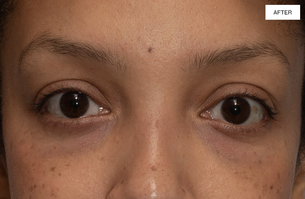 Perfect 360 Eye Illuminate - Dr Sabrina™